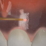 BIOLASE Dental Lasers | Global Leadership in Dentistry