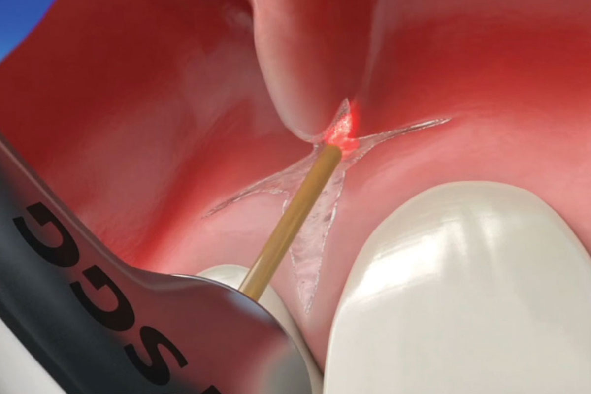 Dental Surgery with Soft Tissue Dental Lasers | BIOLASE