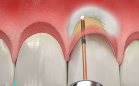 Smile Design Dentistry with Waterlase Dental Lasers | BIOLASE