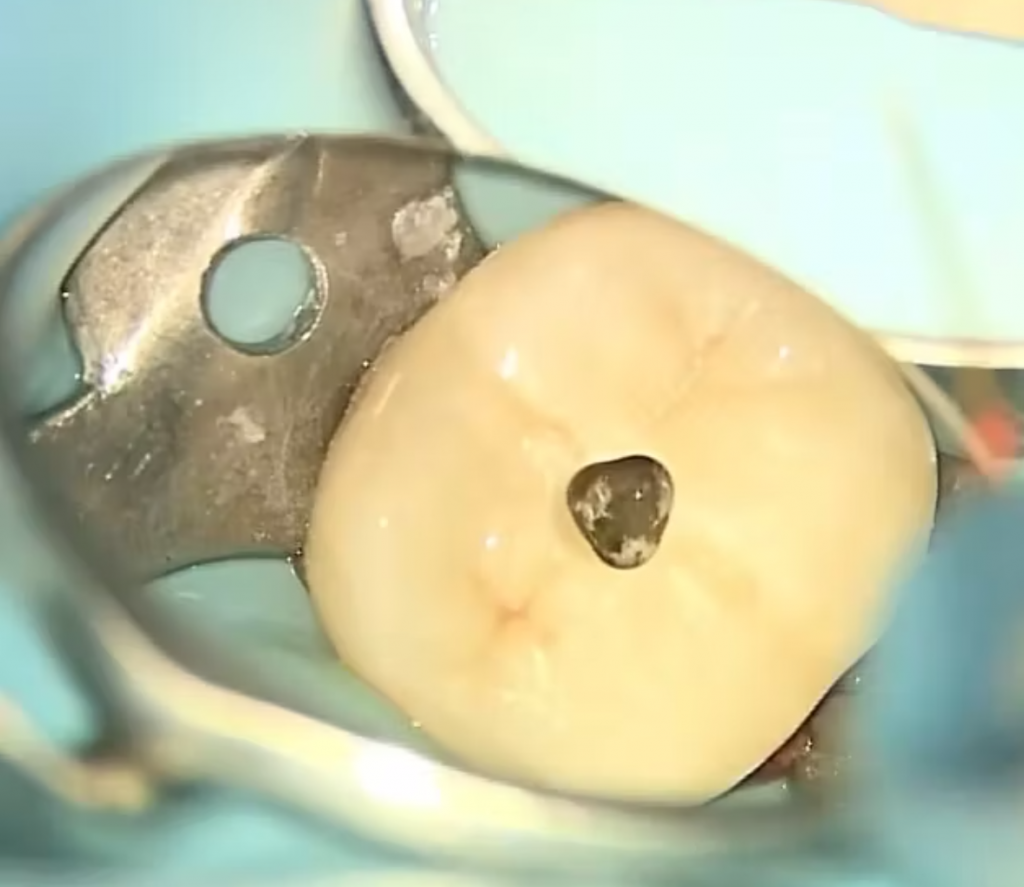 Root Canals and Waterlase Endodontics | BIOLASE