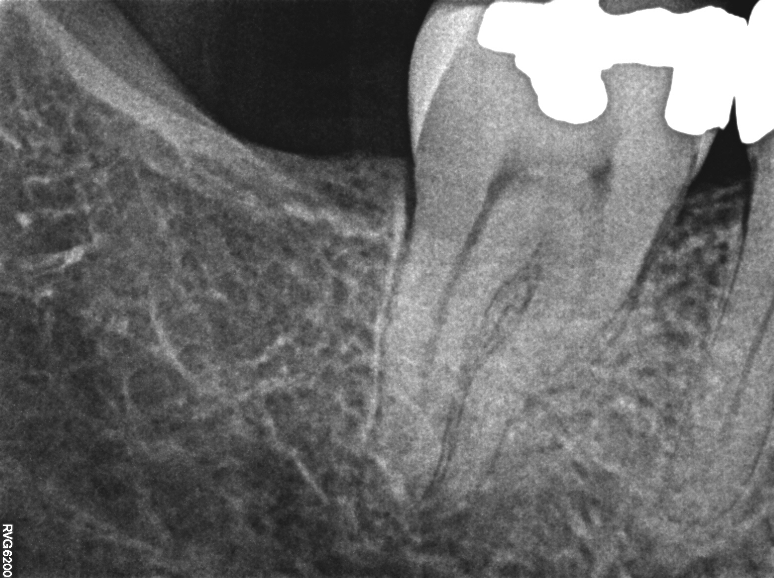 Elevating Endodontics with Dental Lasers | BIOLASE