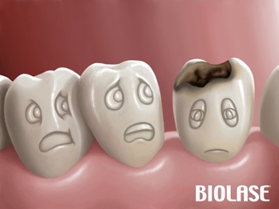 Billions Worldwide Suffer from Untreated Cavities. | BIOLASE