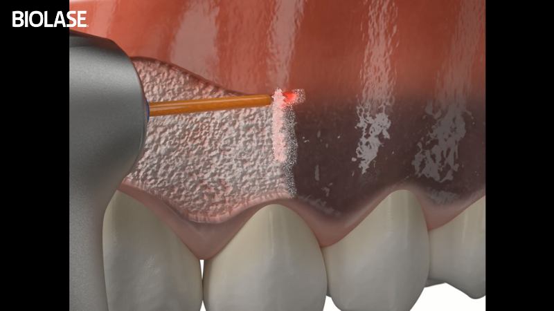Gum Depigmentation with Waterlase | BIOLASE