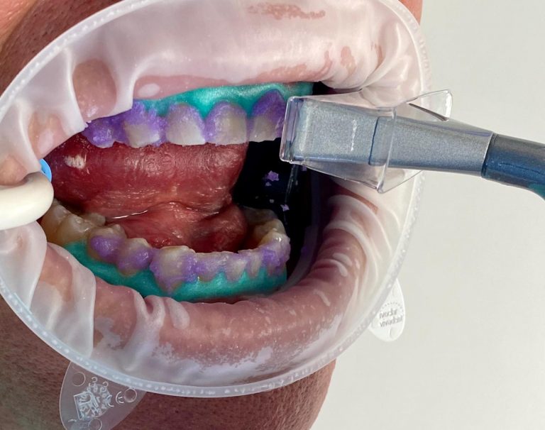 Laser Teeth Whitening with Waterlase | BIOLASE