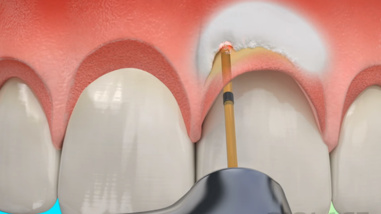 Waterlase iPlus - All Tissue Dental Laser | BIOLASE