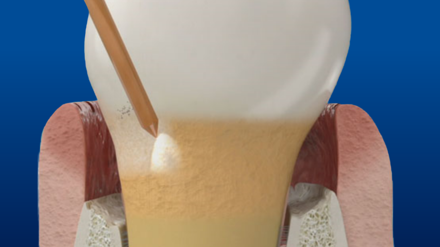 Waterlase iPlus - All Tissue Dental Laser | BIOLASE