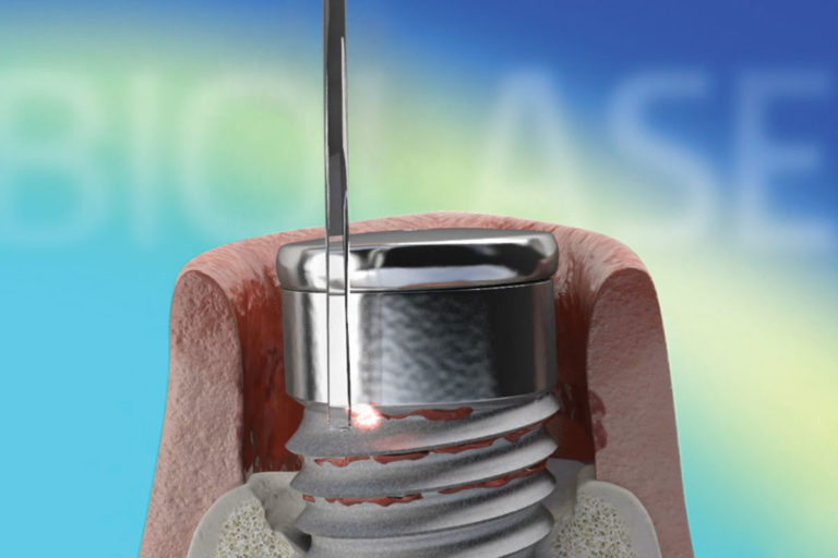 Peri-Implantitis Treatment with Waterlase | BIOLASE