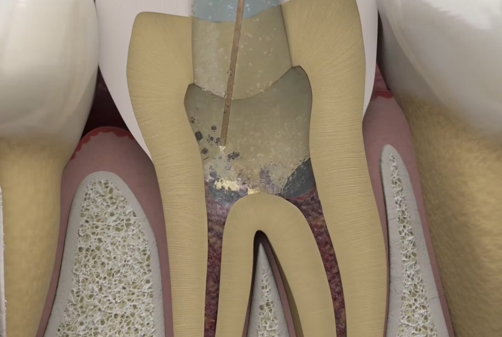 Root Canals and Waterlase Endodontics | BIOLASE