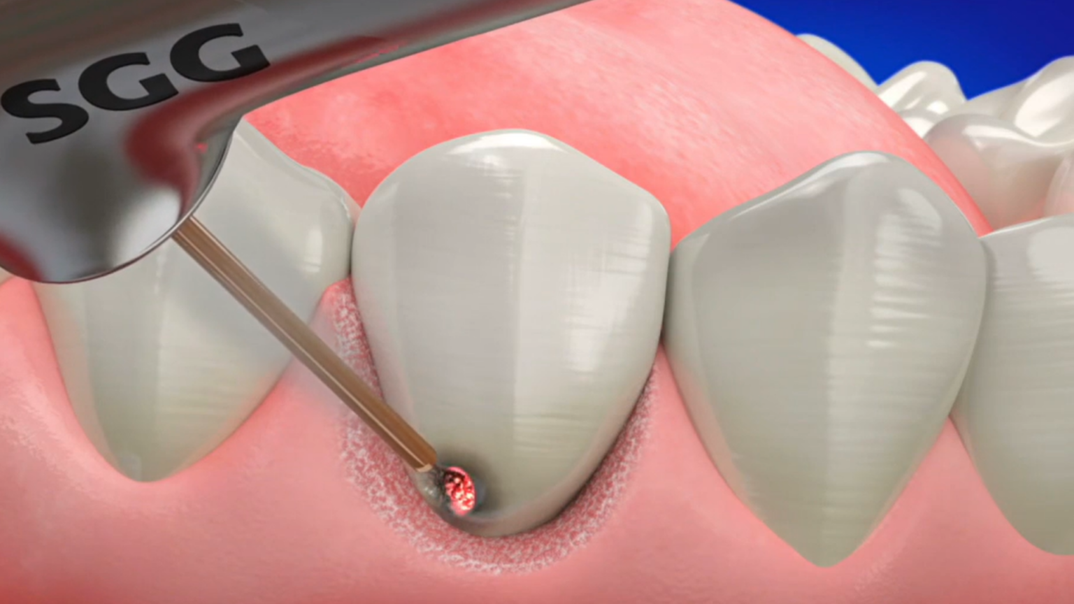 Laser Teeth Whitening with Waterlase | BIOLASE