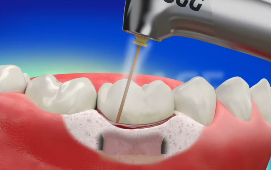 Dental Webinars | BIOLASE